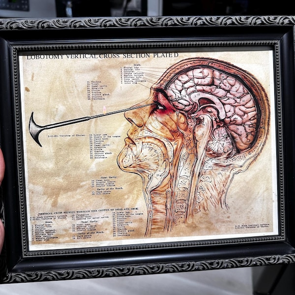 Lobotomy Chart Replica Print (8.5x11) - Etsy