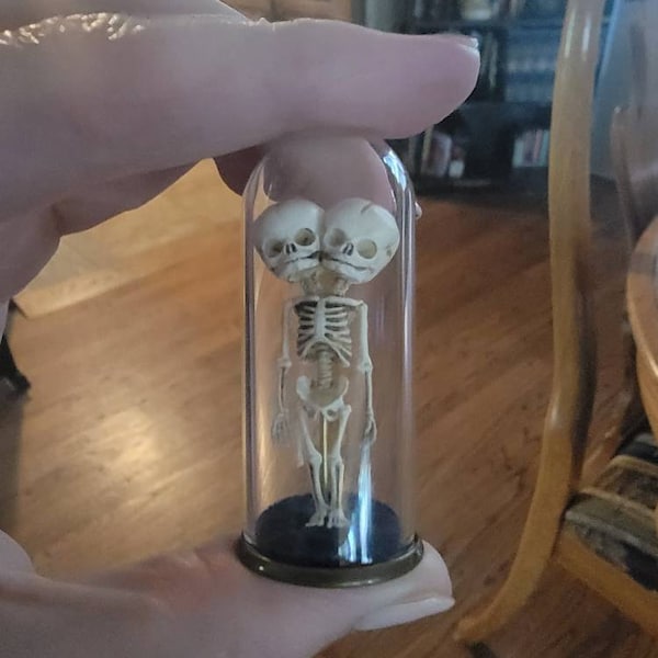 CONJOINED TWINS SKELETON Glass Dome Miniature. Dicephalus Parapagus ...