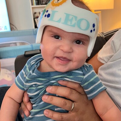 Doc Band Cranial Band Baby Plagiocephaly Helmet Graduate - Etsy