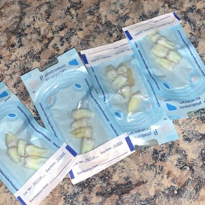 10 CRACKED AND BROKEN Real Human Teeth Molars, Premolars, & Anteriors ...