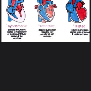 STEMI Vs. NSTEMI - Etsy