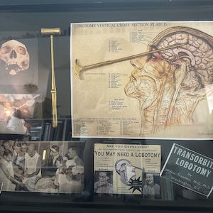 Lobotomy Orbitoclast & Hammer Surgical Medical Tools Shadowbox With ...