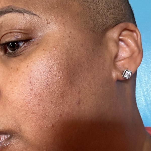 Turmeric Kojic Acid Cleansing Pads Bye Dark Marks Acne ...