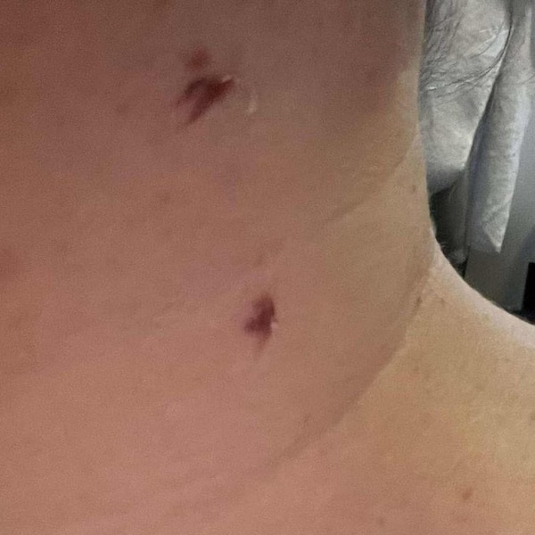 Astarion | Temporary Tattoos | Realistic | Vampire Bite Mark Tattoo | Cosplay | Costume | Scar ...