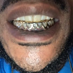 The BEST Mold Kits for Grillz Mold Impression Kit for Custom Grillz ...