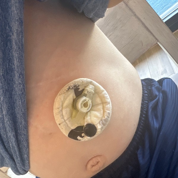 Food G-tube Covers | Gtube Pads | Feeding Tube Pads | Mic-key Button ...