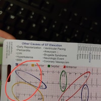 STEMI Reference Tool Vertical Badge Pocket Card for Nurse Paramedic RN ...