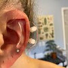 Keloid Compression-'bean' - Etsy