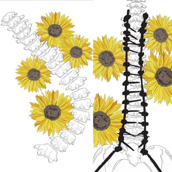 Custom Scoliosis / Spinal Fusion Digital Art Print PRINTABLE File ...