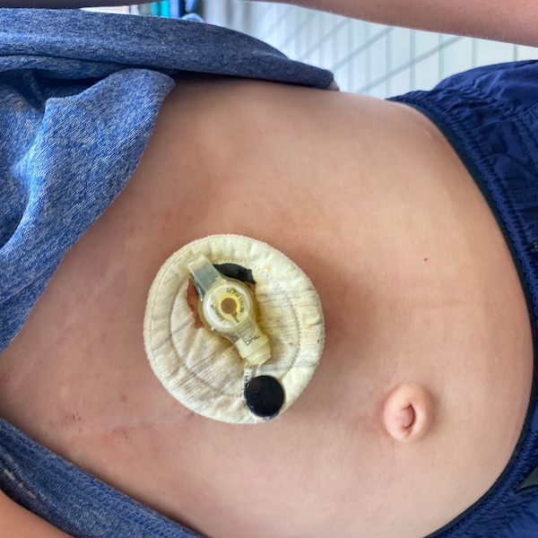 Food G-tube Covers Gtube Pads Feeding Tube Pads Mic-key Button Covers ...