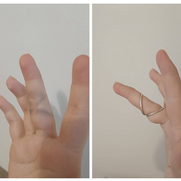 Trigger Finger Splint Ring in Brass, Bronze, Titanium or Silver ...