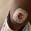 Premium Dexcom G6 Patch Plus Dexcom Transmitter Stickers No Lift ...