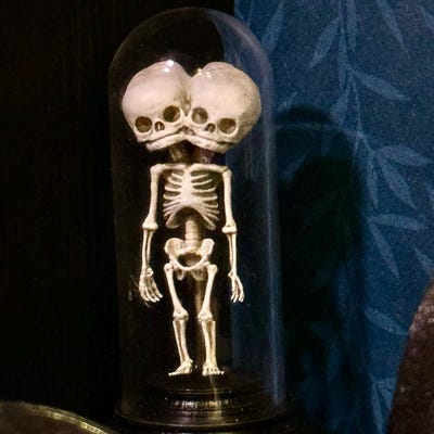 Distressed CONJOINED TWEENS SKELETON. Very Aged Dicephalus Parapagus ...