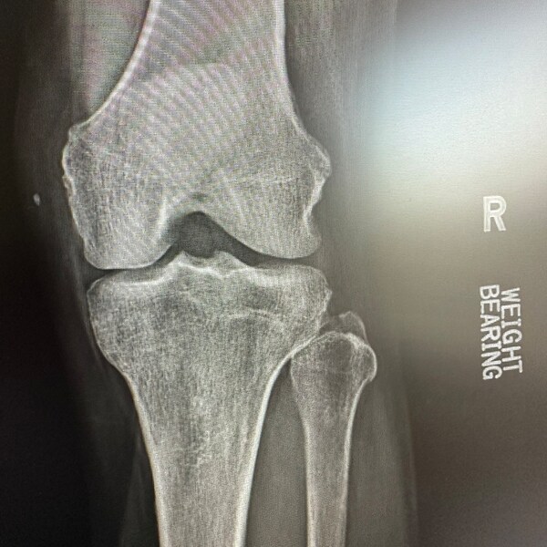 Acrylic X-ray Marker Parker - Etsy