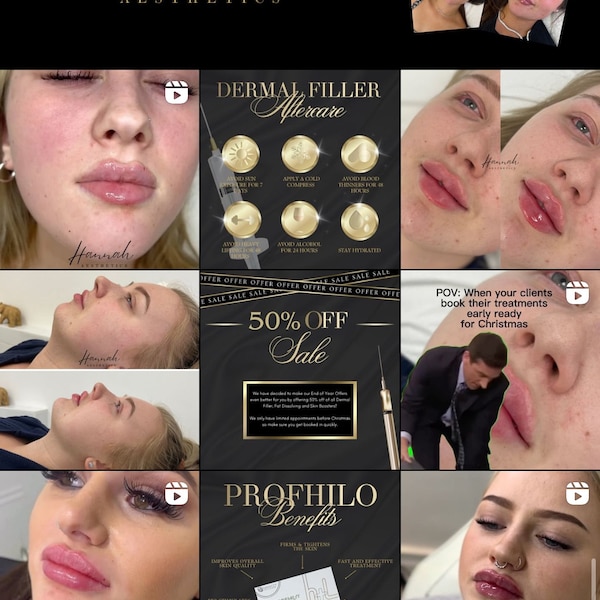 White and Gold Botox and Filler Story & Feed Template | Editable ...