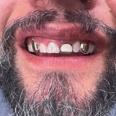 Real Solid 10K Gold Grillz Double Canine Incisor Iced Inlay - Etsy