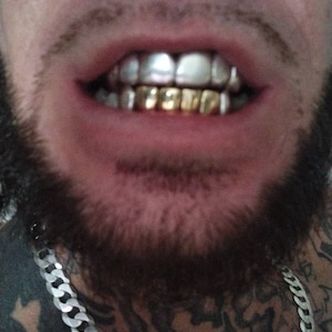 Handmade Custom Dental Gold Top Fangs With Bottom Wolf Style - Etsy