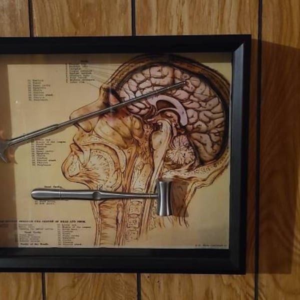 BESTSELLER! Lobotomy Shadowbox Display Large - Etsy