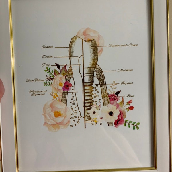 Dental Implant, Dental Surgery, Dentistry Student, Dentist Gift, Dental ...