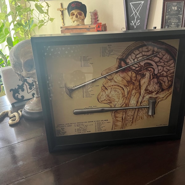 Amputation Bone Saw Shadowbox Display - Etsy