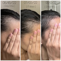 Hair Loss Treatment Hair Growth Cream 2 Month Supply Balding Alopecia ...