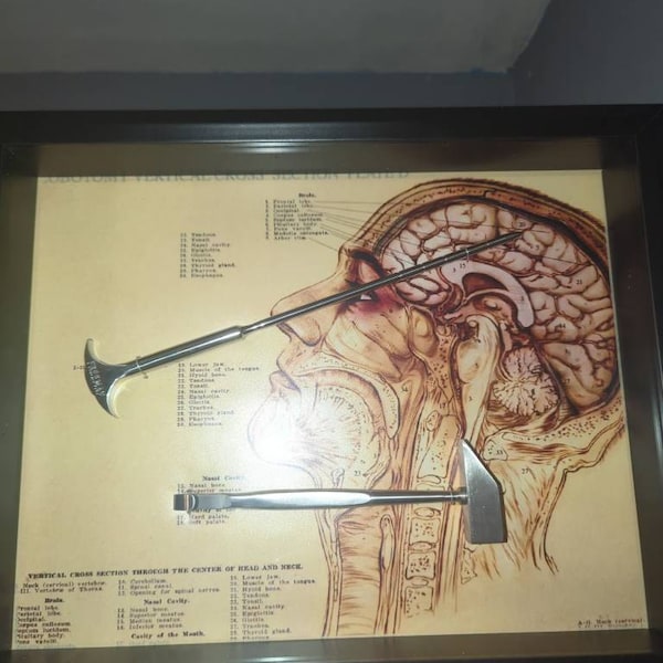 BESTSELLER! Lobotomy Shadowbox Display Large - Etsy