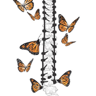 Custom Scoliosis / Spinal Fusion Digital Art Print PRINTABLE - Etsy UK