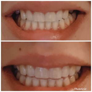 Great Fitting Retainer With Diamonds Customization or Logo.1 Top or ...