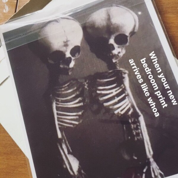 Victorian Siamese Twins Skeleton Art Print 8 X 10 - Anatomical Medical ...