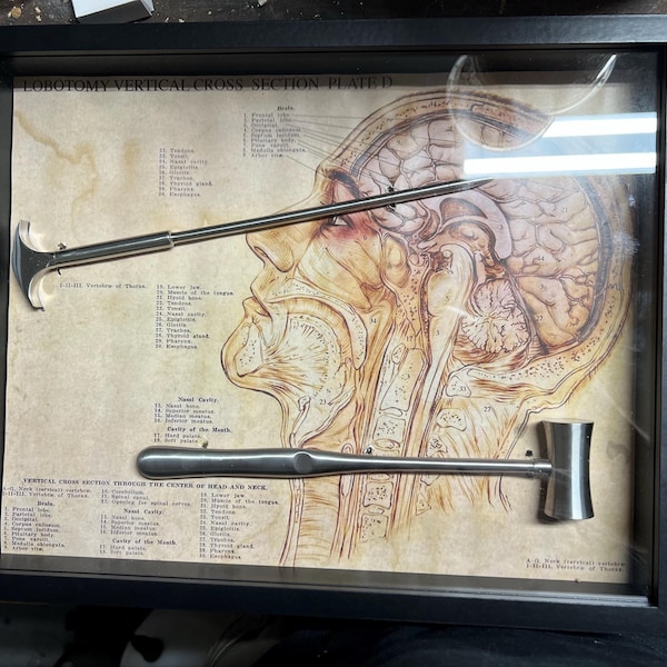 Lobotomy Orbitoclast & Hammer Surgical Medical Tools Shadowbox With ...