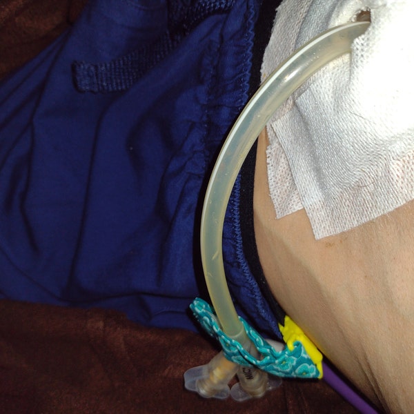 Tube Clips to Help Hold Tubes and Keep Them Separated-chemo and Drain ...