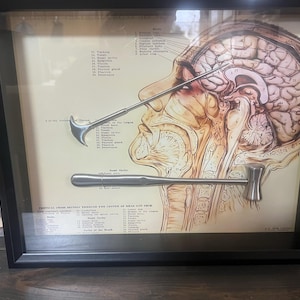 BESTSELLER! Lobotomy Shadowbox Display Large - Etsy
