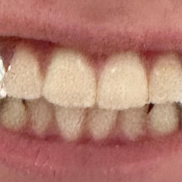 Custom Grillz With Extended K9s and Back Bar - Etsy