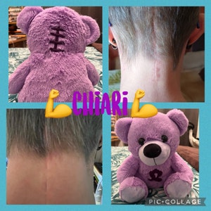 Chiari Malformation zipperhead Awareness 12 Bear Purple, Awareness ...