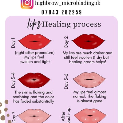 Lip Filler Stages of Healing With Hand Drawn Illustrations, Hyaluron ...