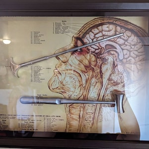 Infant & Child Embalming Trocar / Drain Tube - Etsy