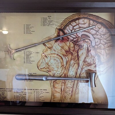BESTSELLER Lobotomy Shadowbox Display Large - Etsy