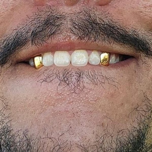 Custom 1 Open Face Tooth Cap Grillz - Etsy