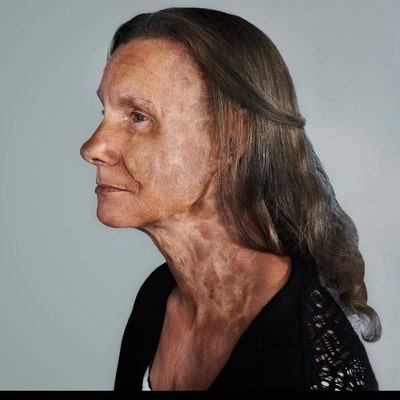 Burn Scars Set Silicone Prosthetic Appliances // Encapsulated Silicone ...