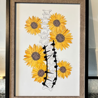 Custom Scoliosis / Spinal Fusion Digital Art Print PRINTABLE - Etsy UK