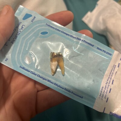 10 CRACKED AND BROKEN Real Human Teeth Molars, Premolars, & Anteriors ...