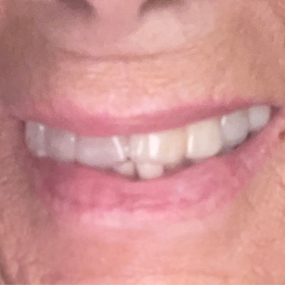 Great Fitting Retainer With Diamonds Customization or Logo.1 Top or ...