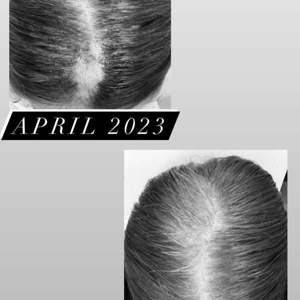 Hair Loss Treatment Hair Growth Cream 2 Month Supply Balding Alopecia ...
