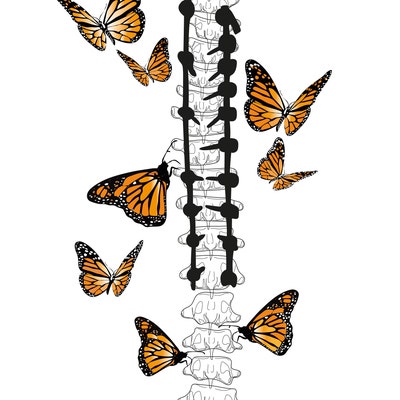 Custom Scoliosis / Spinal Fusion Digital Art Print PRINTABLE - Etsy UK