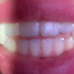 Great Fitting Retainer With Diamonds Customization or Logo.1 Top or ...