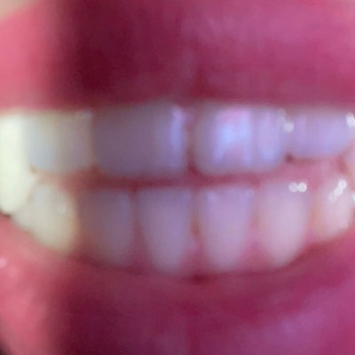 Great Fitting Retainer With Diamonds Customization or Logo.1 Top or ...