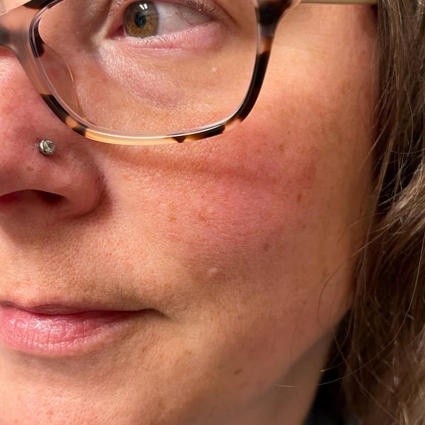 Silver Color Implant Grade Titanium Threadless Push Pin 2mm, 2.5mm, 3mm ...