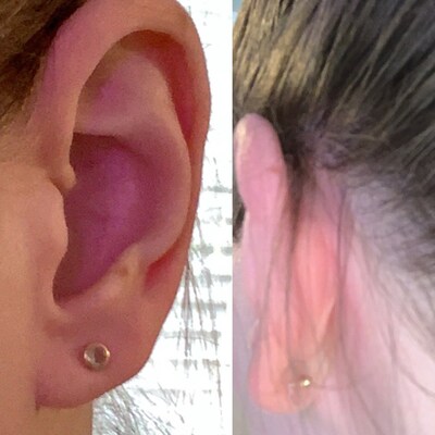 Reusable-rare Smaller EAR LOBE SUPPORTS Ear Lifts Strong Round Plastic ...