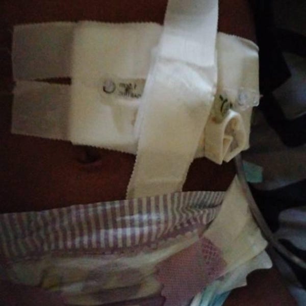 6 Pack G Tube Pads, Buttons Feeding Tube G-tube Mic-key Button Feeding ...