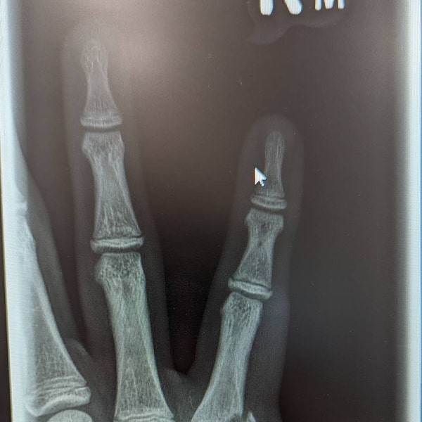 Ghost Xray Markers up to 3 Letters or Numbers Radiology, Xray Markers ...